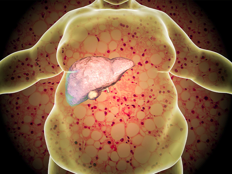 Yağlı Karaciğer Hastalıkları - Tkad